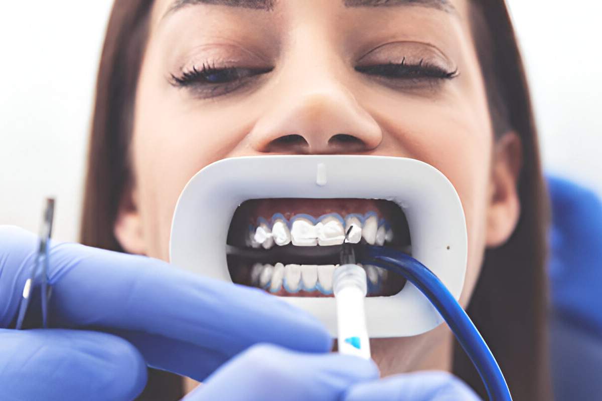 Do Teeth Whitening Strips Work?