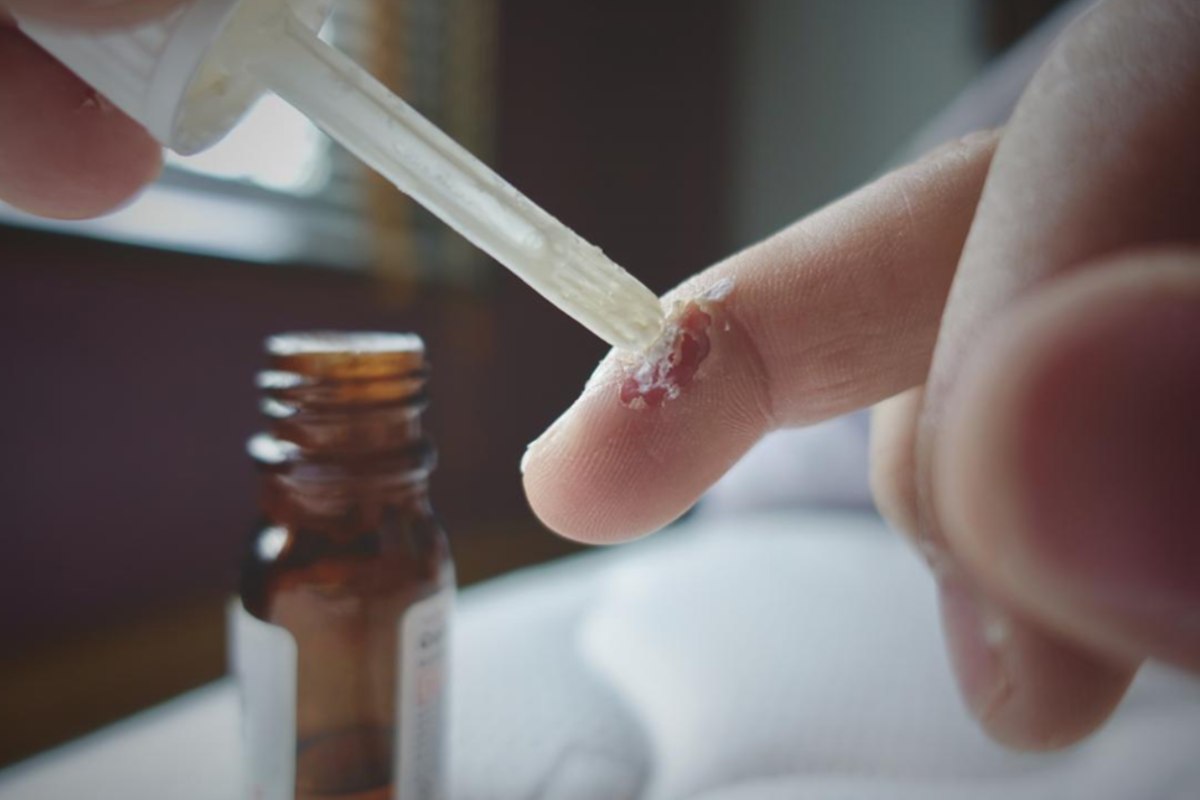 The Essential Guide to Using Oils for Warts